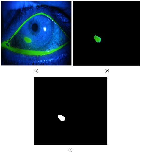 Corneal Ulcer Fluorescein