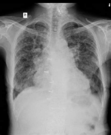 On 1222 Chest Pa View Suggest Of Reticular Opacities In Bilateral