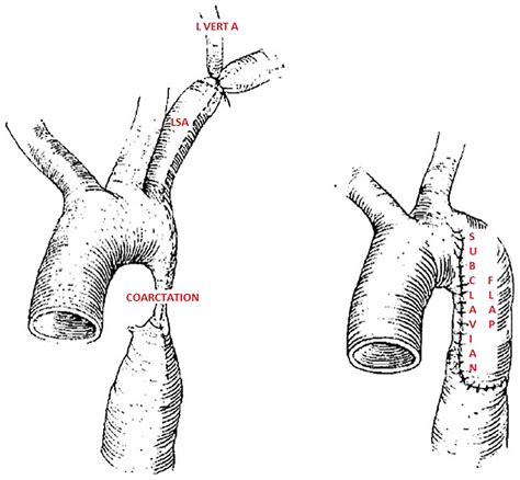 Vertebrobasilar Insufficiency After Subclavian Flap Aortoplasty For