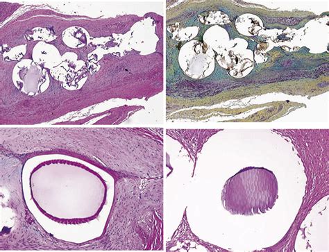 Characterization Of Acrylic Polyamide Plastic Embolization Particles In