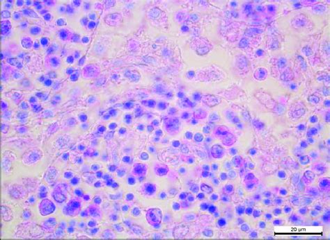 Lymph Node Of A Cat With Fip Lumen Of Sinuses Of Rounded Cells With Download Scientific