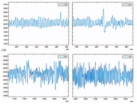 Figure 8 From The Use Of An Inductive Sensor In The Assessment Of Respiratory System Efficiency