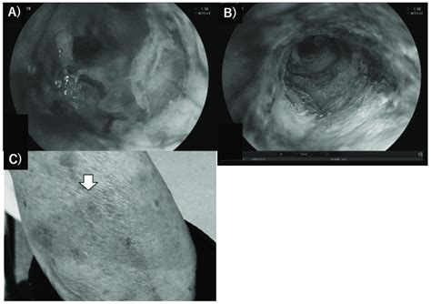 A Cholangioscopy Findings Showed Encircled Cancer Stenosis B