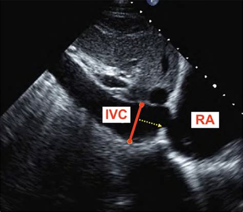 Real Time Echocardiography Image Analysis And Quantification Of Cardiac Indices Abstract