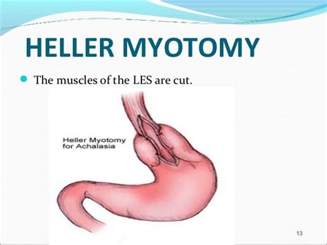 Fundoplication And Hellers Myotomy