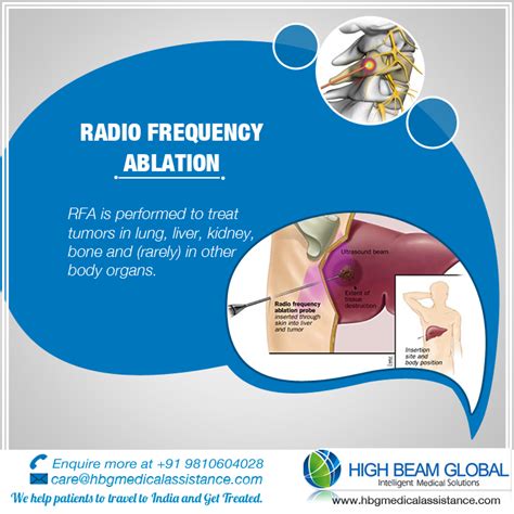 Radio Frequency Ablation Rfa Is A Medical Procedure Where Part Of The