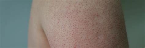Keratosis Pilaris Treatment The Reddish Bumps On The Back Of The