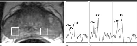 Mr Imaging Mr Spectroscopic Imaging And Pathologic Data In A Download Scientific Diagram