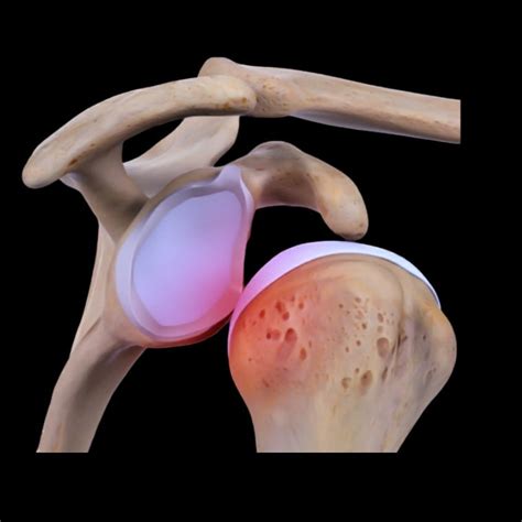 Arthroscopy Bankart Repair For Shoulder Dislocation Dr Sachin Jain Ortho