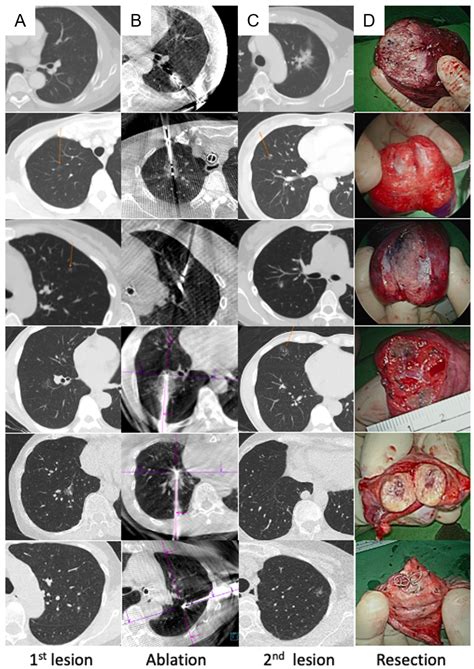 Single Stage Image Guided Percutaneous Ablation With Thoracoscopic Resection For Multiple