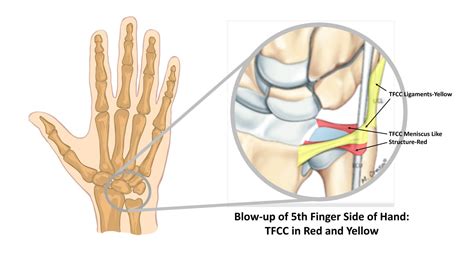 Tfcc Surgery Issues And Jennifer S Story Regenexx