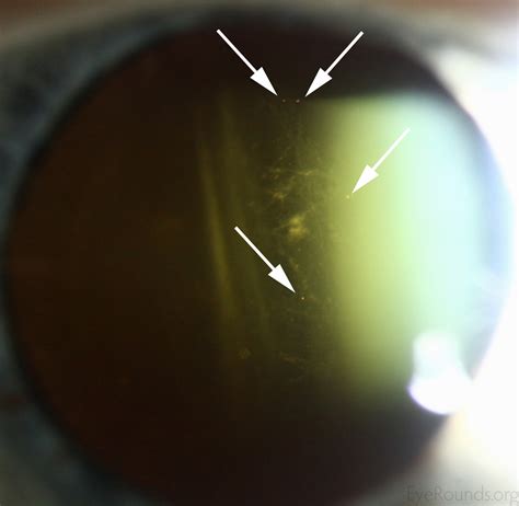 Posterior Vitreous Detachment