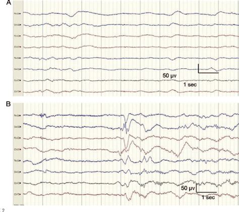 Value Of Eeg In Outcome Prediction Of Hypoxic Ischemic 56 Off