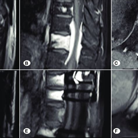 Proposed Treatment Algorithm For Spinal Lymphomas Download