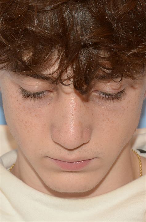 Sinus Surgery 2 Robert A Guida Md Pc