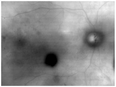 Representative Example Of Choroidal Nevus In The Healthy Eye Of A Download Scientific Diagram
