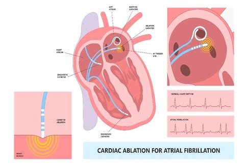 Heart Catheter Ablation At Ryder Sidaway Blog