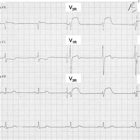 Right Sided Precordial Leads In Mr B Notice That When Recording The