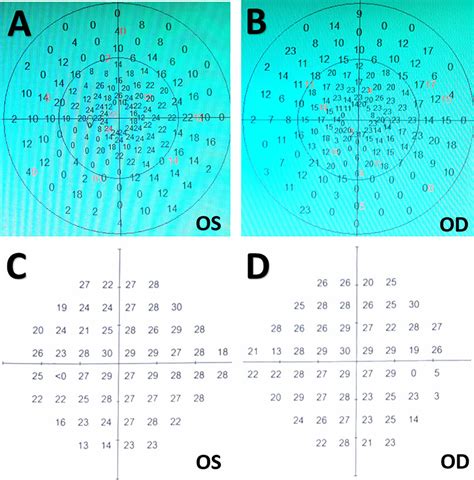Visual Field Tests Before And After Surgery A B Preoperative Download Scientific Diagram