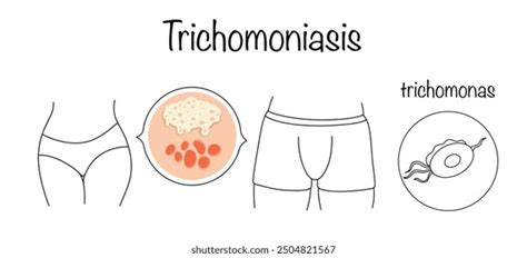 Sexually Transmitted Diseases Stds Más De 74 Ilustraciones Y Dibujos