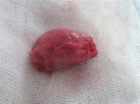 Enucleation V Dental Hospitals