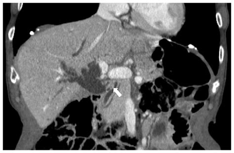 image acquired from multi detector row computed tomography revealing