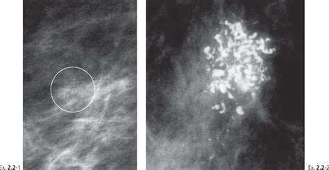 Group 1 One Or Two Clusters Of Crushed Stone Like Calcifications Of The Mammogram Produced By