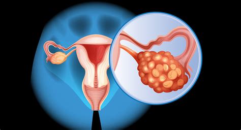 Ovary Vs Appendix Location