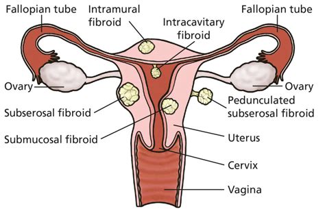 Fibroids Leeds Teaching Hospitals Nhs Trust