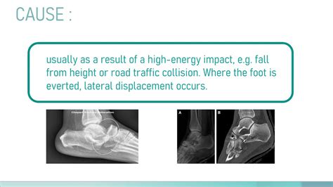Calcaneocuboid Dislocation