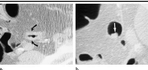 Prone And Supine Reformation Transverse 2d Ct Colonographic Images A Download Scientific