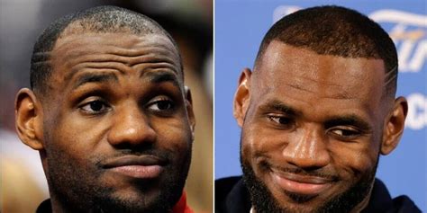 Lebron James Hair Transplant Impact Techniques And Celebrity Trends