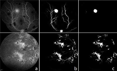 Figure 1 From Automated Retinal Lesion Detection Via Image Saliency Analysis Semantic Scholar