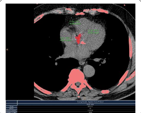 Calculation Of The Ct Calcium Score For The Aortic Valve Showing Download Scientific Diagram