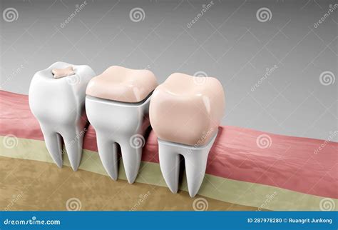 Teeth With Different Types Of Dental Filling Oral Health And Dental