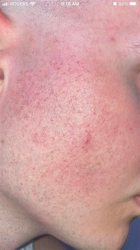 Fungal Acne Before Vs After Treated Using Only Head And Shoulders