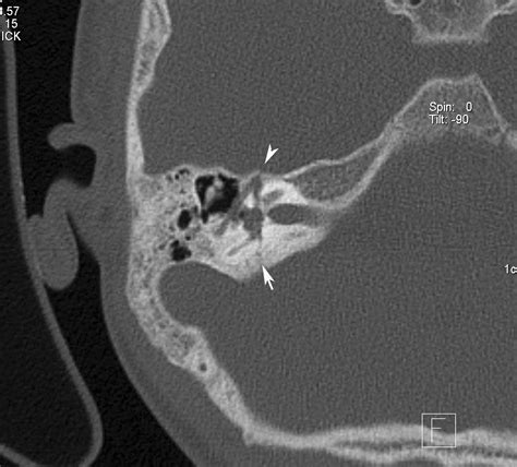 radiodiagnosis imaging is amazing interesting cases temporal bone