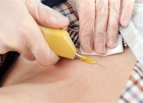 110개 이상의 혈관 확장 이미지 스톡 사진 그림 및 Royalty Free 이미지 Istock