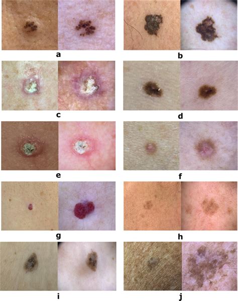 Malignant Skin Lesions