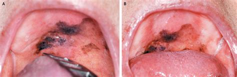Melanoma Of The Oral Cavity New England Journal Of Medicine