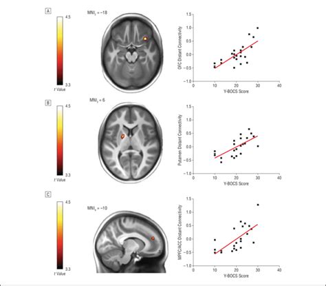 positive correlation between overall obsessive compulsive disorder