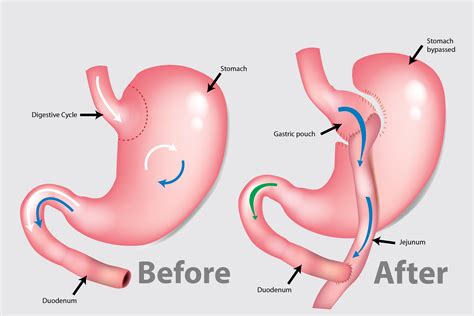 Gastric Bypass Radiology Anatomy At Rosetta Cogan Blog