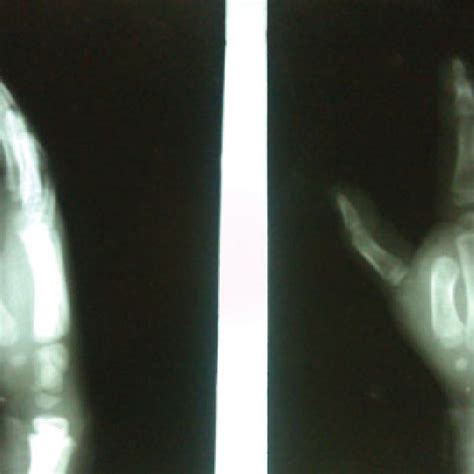 Clinical Picture Of Metacarpophalangeal Joint Dislocation Of Thumb In Download Scientific