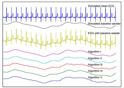 A Dual Adaptive Approach Based On Discrete Cosine Transform For Removal Of Ecg Baseline Wander