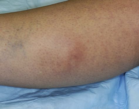 Erythema Nodosum Babe Of Medicine