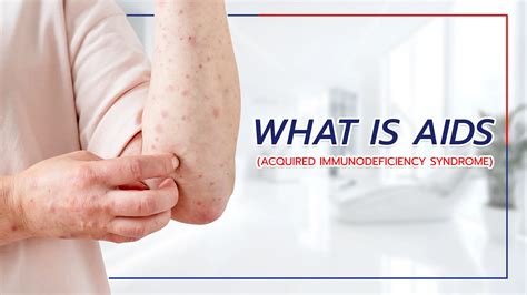 Aids Dangerous Whatre Symptoms Can Treated Or Prevented Bangkok