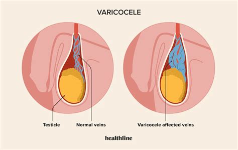Varicocele Treatment In Kenya 3 Expert Solutions For You