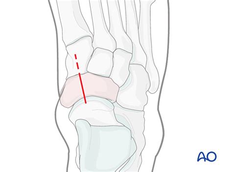 Primary Fusion Of Naviculocuneiform Joint For Complete Articular Navicular Fracture
