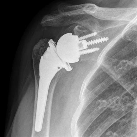Dr Mcclintocks Shoulder X Ray Image Gallery Kyle Mcclintock Do