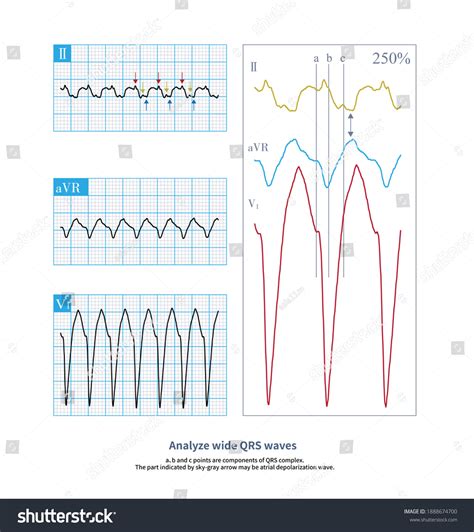 Atrial Depolarization